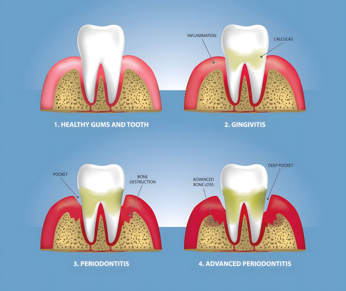 Gum Disease Treatment | Jordan Springs Dental