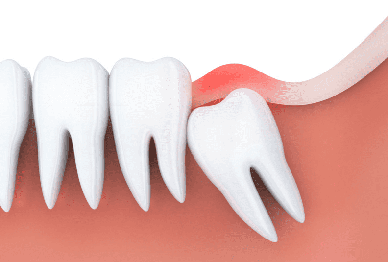 Wisdom Teeth Removal | Jordan Springs Dental Care